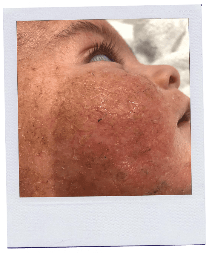 3-Steps to Eczema Free Skin #5 - The Children's Naturopath